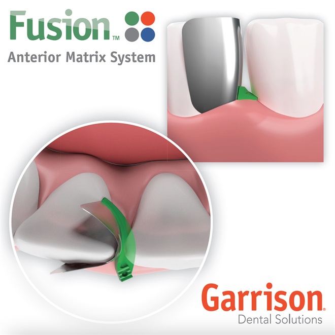 Garrison Dental Composi Tight 3D Fusion: Sectional Kit Of Matrices For