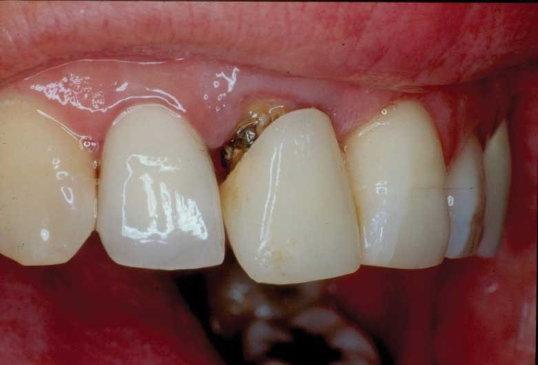 Erupting Compromised Teeth for Restoration by Dr. Joe Whitehouse ...