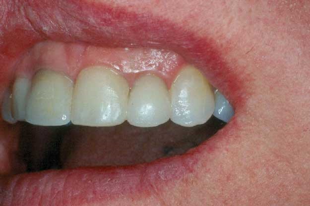 Erupting Compromised Teeth for Restoration by Dr. Joe Whitehouse ...