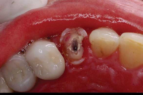 Erupting Compromised Teeth for Restoration by Dr. Joe Whitehouse ...