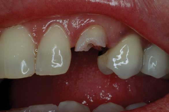 Erupting Compromised Teeth for Restoration by Dr. Joe Whitehouse ...