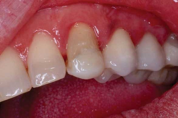 Erupting Compromised Teeth for Restoration by Dr. Joe Whitehouse ...