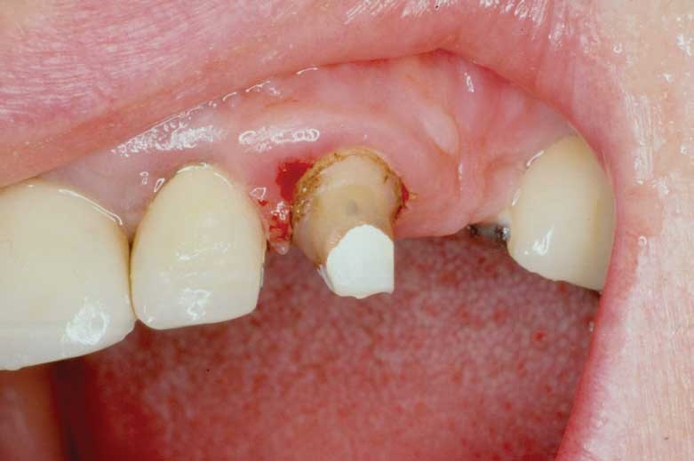 Erupting Compromised Teeth for Restoration by Dr. Joe Whitehouse ...