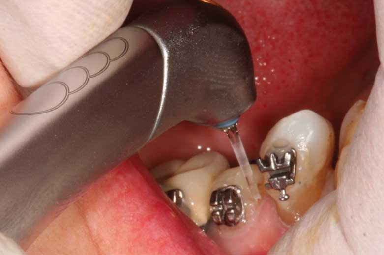 Erupting Compromised Teeth for Restoration by Dr. Joe Whitehouse ...