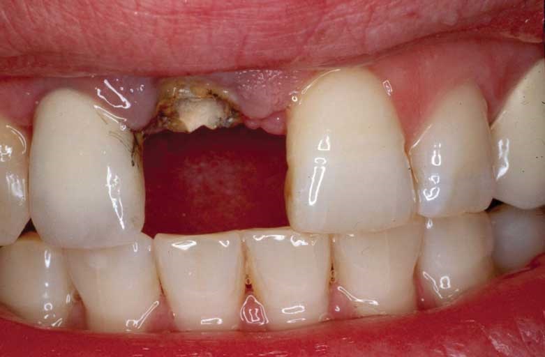 Erupting Compromised Teeth for Restoration by Dr. Joe Whitehouse ...
