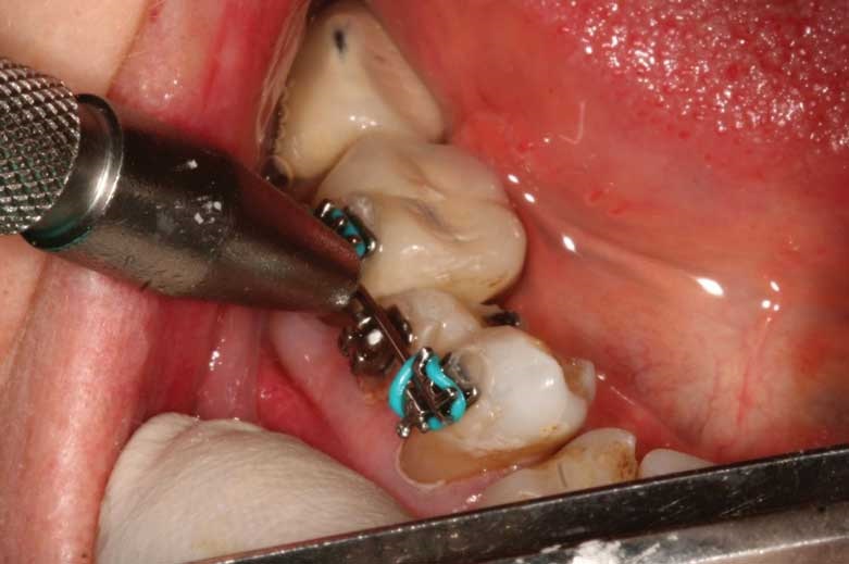 Erupting Compromised Teeth for Restoration by Dr. Joe Whitehouse ...