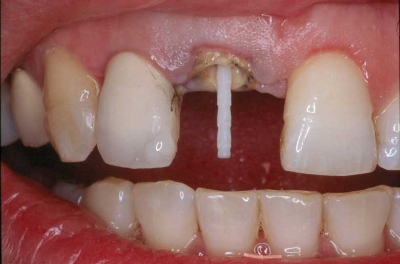 Erupting Compromised Teeth for Restoration by Dr. Joe Whitehouse ...