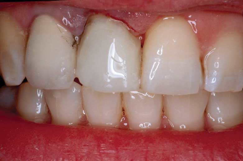 Erupting Compromised Teeth for Restoration by Dr. Joe Whitehouse ...