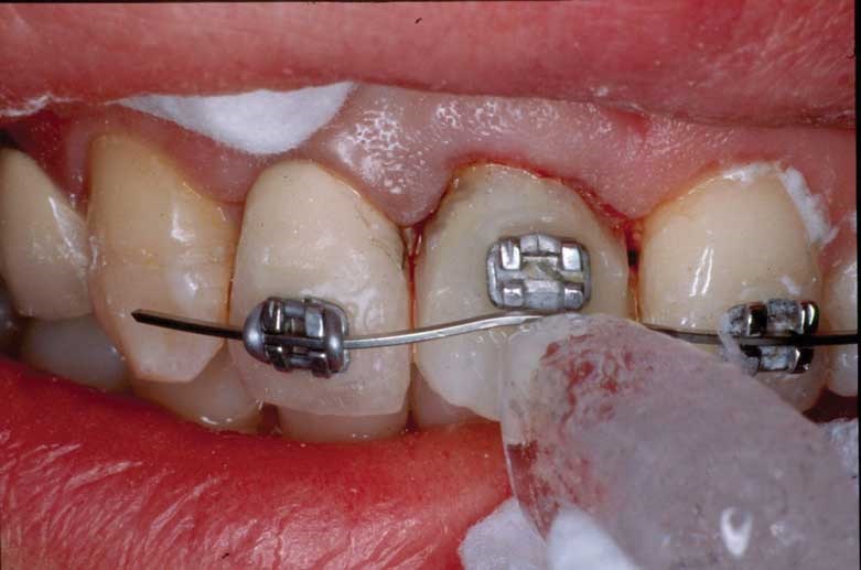 Erupting Compromised Teeth for Restoration by Dr. Joe Whitehouse ...