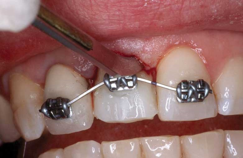 Erupting Compromised Teeth for Restoration by Dr. Joe Whitehouse ...
