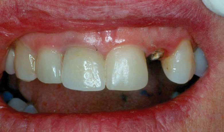 Erupting Compromised Teeth for Restoration by Dr. Joe Whitehouse ...