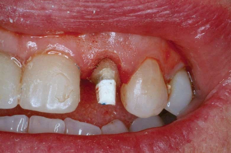 Erupting Compromised Teeth for Restoration by Dr. Joe Whitehouse ...