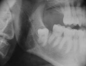 Prophylactic Removal of Third Molars by Dr. Jay B. Reznick - Dentaltown