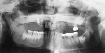 Prophylactic Removal of Third Molars by Dr. Jay B. Reznick - Dentaltown