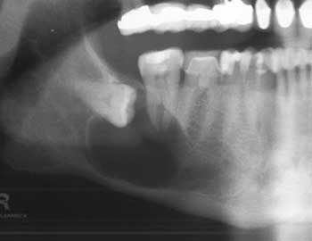 Prophylactic Removal of Third Molars by Dr. Jay B. Reznick - Dentaltown