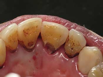 Show Your Work: Restoring Deep Root Caries by Dr. Ahmad Fayad - Dentaltown