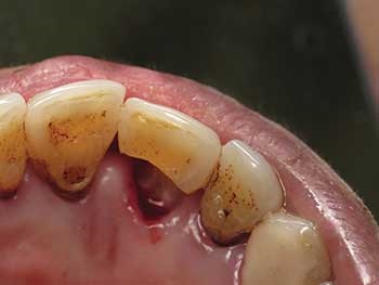 Show Your Work: Restoring Deep Root Caries by Dr. Ahmad Fayad - Dentaltown