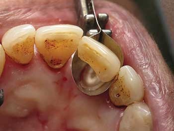 Show Your Work: Restoring Deep Root Caries by Dr. Ahmad Fayad - Dentaltown