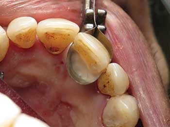 Show Your Work: Restoring Deep Root Caries by Dr. Ahmad Fayad - Dentaltown