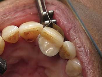 Show Your Work: Restoring Deep Root Caries by Dr. Ahmad Fayad - Dentaltown