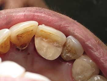 Show Your Work: Restoring Deep Root Caries by Dr. Ahmad Fayad - Dentaltown