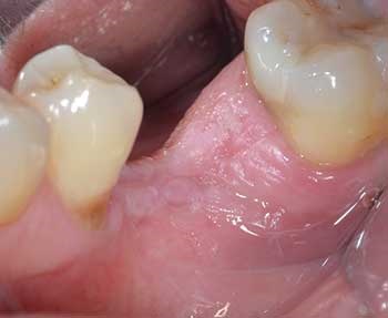 Peri-Implant Guided Bone Regeneration by Dr. Giacomo Tarquini - Dentaltown