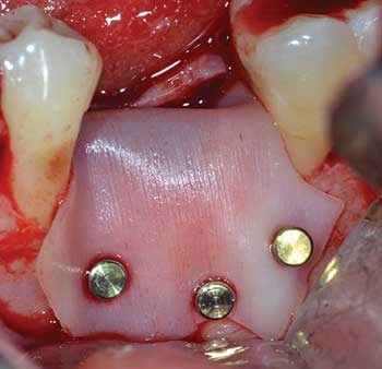 Peri-Implant Guided Bone Regeneration by Dr. Giacomo Tarquini - Dentaltown