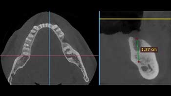 Peri-Implant Guided Bone Regeneration by Dr. Giacomo Tarquini - Dentaltown