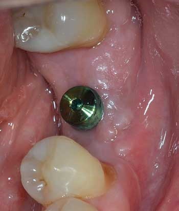 Peri-Implant Guided Bone Regeneration by Dr. Giacomo Tarquini - Dentaltown