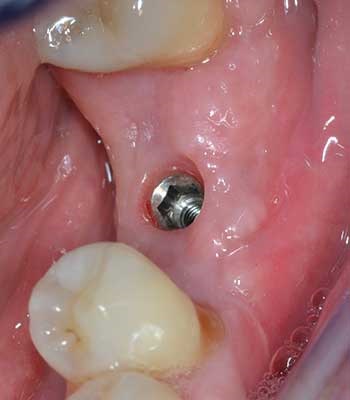 Peri-Implant Guided Bone Regeneration by Dr. Giacomo Tarquini - Dentaltown