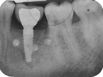 Peri-Implant Guided Bone Regeneration by Dr. Giacomo Tarquini - Dentaltown