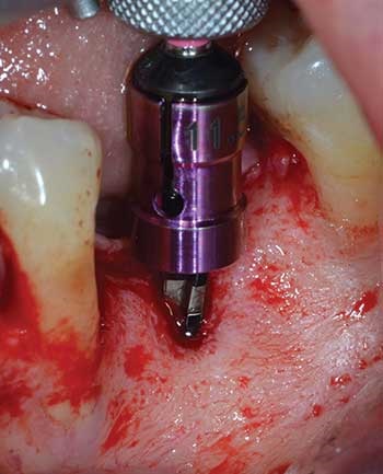 Peri-Implant Guided Bone Regeneration by Dr. Giacomo Tarquini - Dentaltown