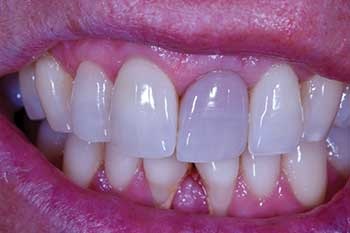 Bleaching Discolored Endodontically Treated Teeth by Dr. Terry Shaw ...