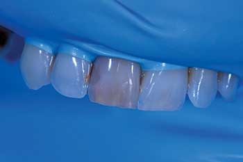 Bleaching Discolored Endodontically Treated Teeth by Dr. Terry Shaw ...