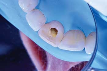 Bleaching Discolored Endodontically Treated Teeth by Dr. Terry Shaw ...