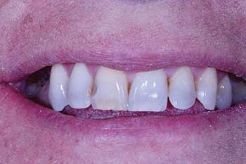 Bleaching Discolored Endodontically Treated Teeth by Dr. Terry Shaw ...