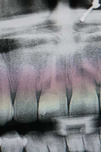 Bleaching Discolored Endodontically Treated Teeth by Dr. Terry Shaw ...