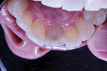 Bleaching Discolored Endodontically Treated Teeth by Dr. Terry Shaw ...