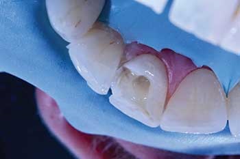 Bleaching Discolored Endodontically Treated Teeth by Dr. Terry Shaw ...