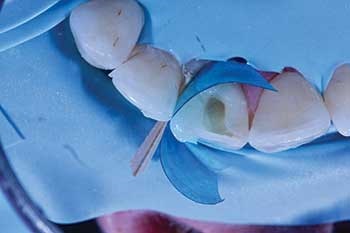 Bleaching Discolored Endodontically Treated Teeth by Dr. Terry Shaw ...