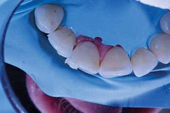 Bleaching Discolored Endodontically Treated Teeth by Dr. Terry Shaw ...