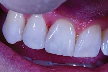 Bleaching Discolored Endodontically Treated Teeth by Dr. Terry Shaw ...