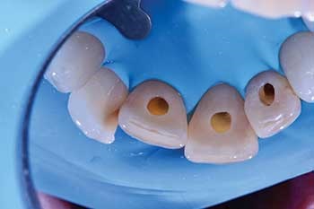 Bleaching Discolored Endodontically Treated Teeth by Dr. Terry Shaw ...