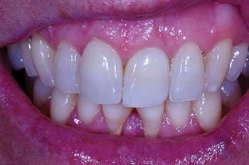 Bleaching Discolored Endodontically Treated Teeth by Dr. Terry Shaw ...