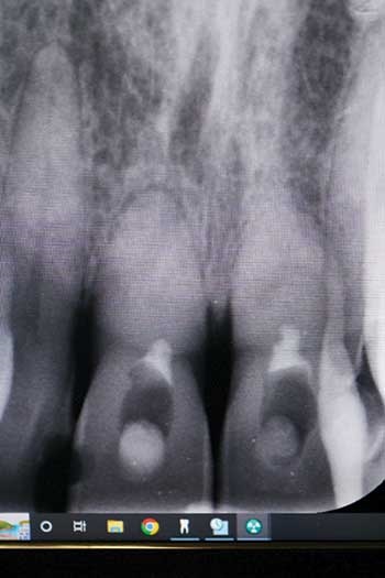 Bleaching Discolored Endodontically Treated Teeth by Dr. Terry Shaw ...
