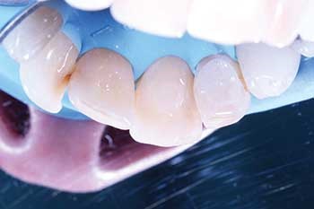 Bleaching Discolored Endodontically Treated Teeth by Dr. Terry Shaw ...