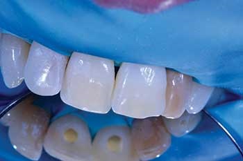 Bleaching Discolored Endodontically Treated Teeth by Dr. Terry Shaw ...