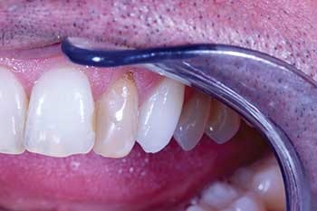 Bleaching Discolored Endodontically Treated Teeth by Dr. Terry Shaw ...