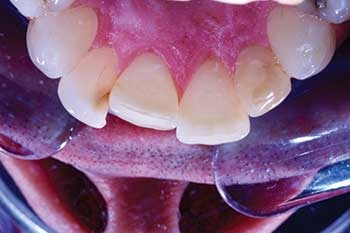 Bleaching Discolored Endodontically Treated Teeth by Dr. Terry Shaw ...