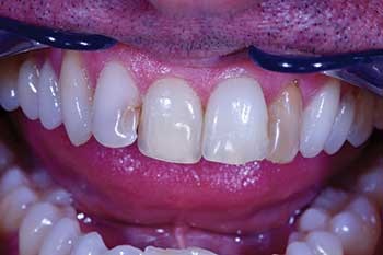 Bleaching Discolored Endodontically Treated Teeth by Dr. Terry Shaw ...